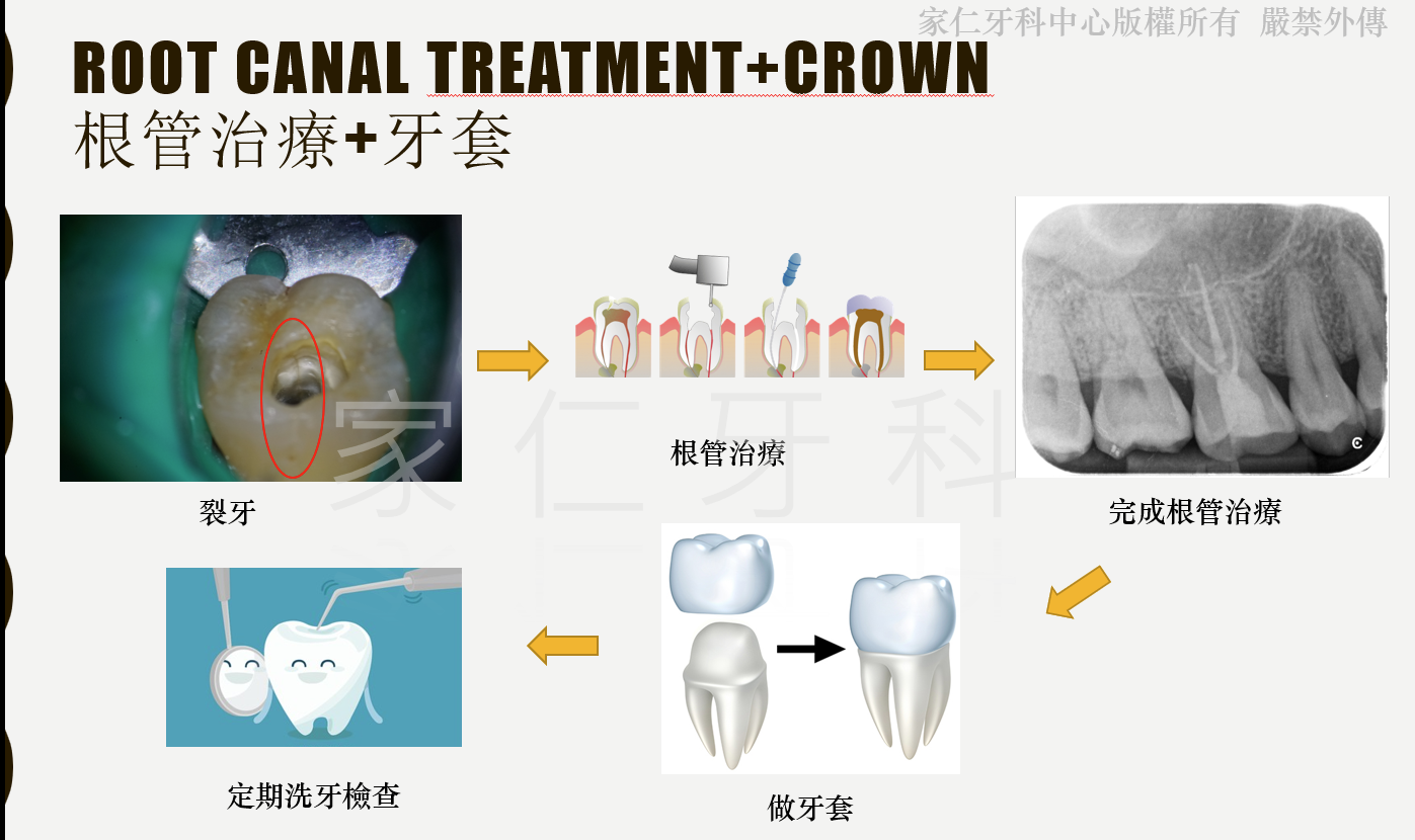Root Canal Treatment? Checklist to identify failed ones